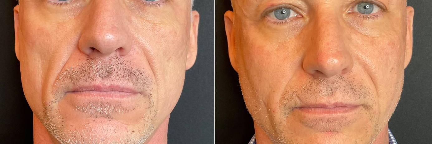 Sculptra Before and After - In depth article - Marx-Med